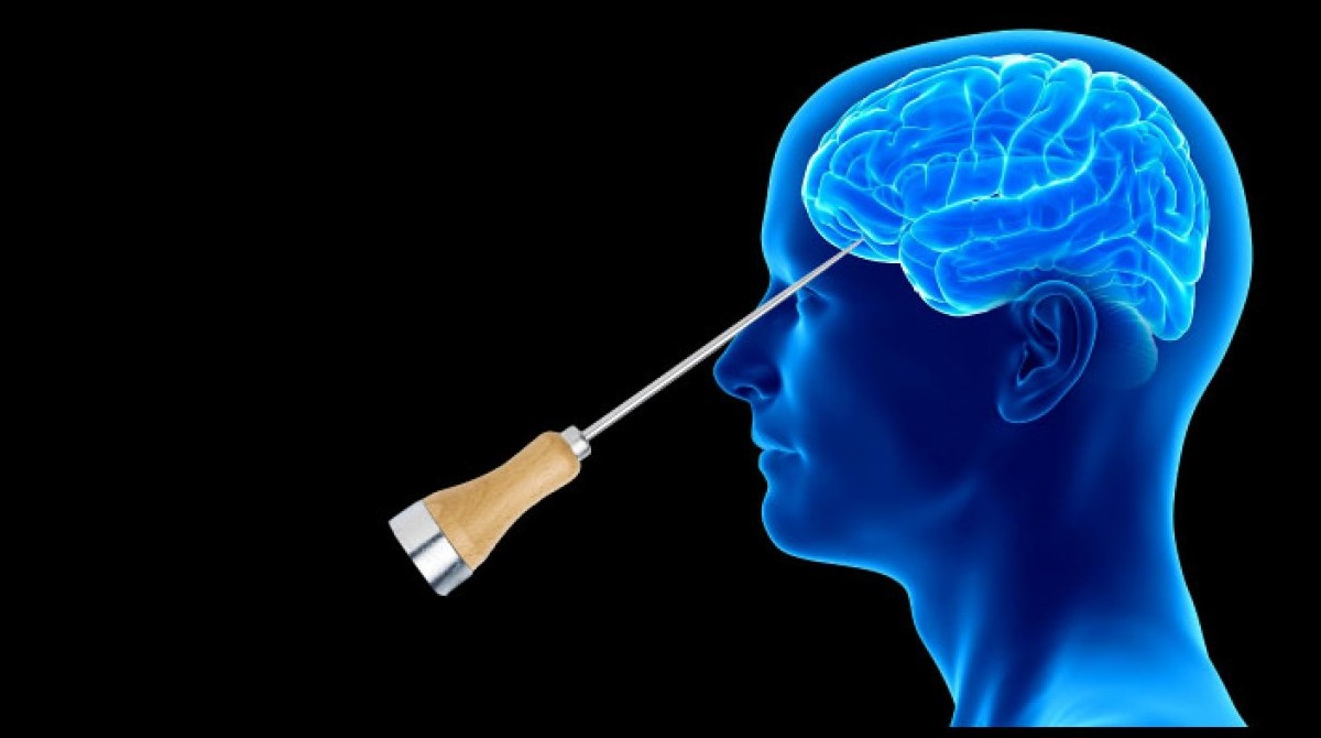 ᐈ Лоботомія: 8 фактів про операцію, якої люди боялися віками | Discover ...